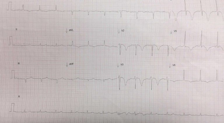Wellens waves | Emergency Medicine Education | Resus