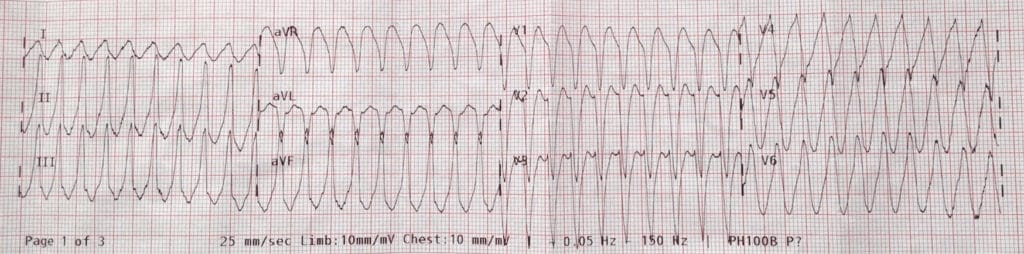 SVT with Aberrancy | Emergency Medicine Education | Resus