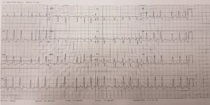 The Unstable Atrial Fibrillation Patient | Resus