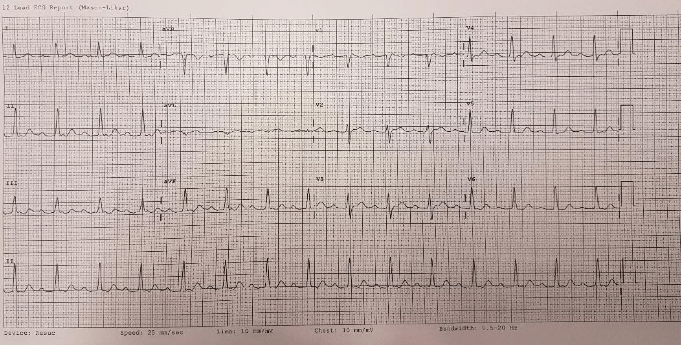 The Unstable Atrial Fibrillation Patient | Resus