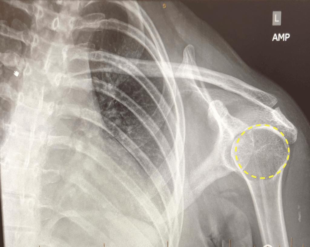 The 'Lightbulb Sign' doesn't always mean a posterior dislocation