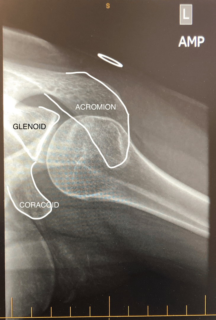 The 'Lightbulb Sign' doesn't always mean a posterior dislocation