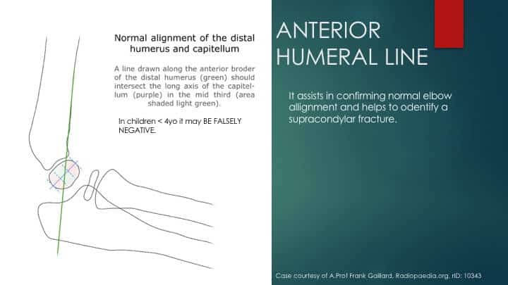 Elbow Fractures | Emergency Medicine Education | Resus