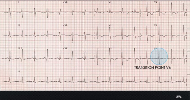 ECG of Pulmonary Embolism | Emergency Medicine Education | Resus