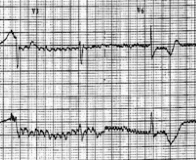 Runaway Pacemaker and Lethal Arrhythmia | Resus