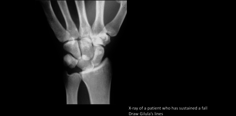 Gilula's Carpal Arcs | Emergency Medicine Education | Resus