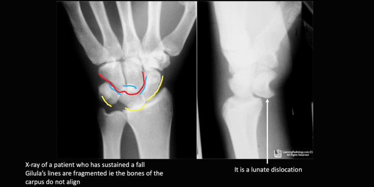 Gilula's Carpal Arcs | Emergency Medicine Education | Resus