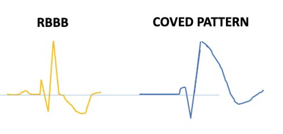 Brugada Syndrome | Emergency Medicine Education | Resus
