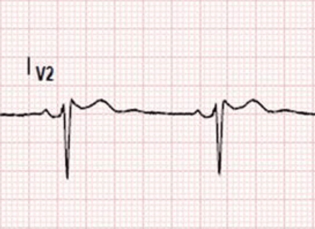 Brugada Syndrome | Emergency Medicine Education | Resus