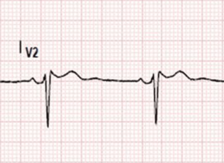 Brugada Syndrome | Emergency Medicine Education | Resus