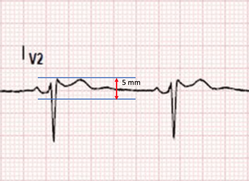 Brugada Syndrome | Emergency Medicine Education | Resus