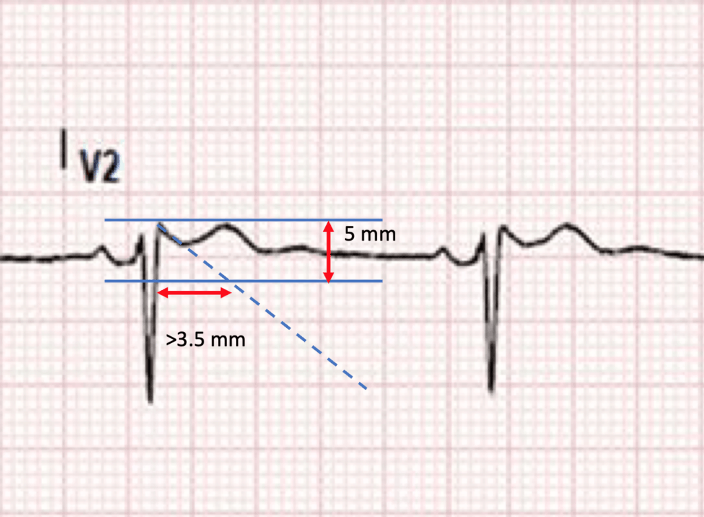 Brugada Syndrome | Emergency Medicine Education | Resus