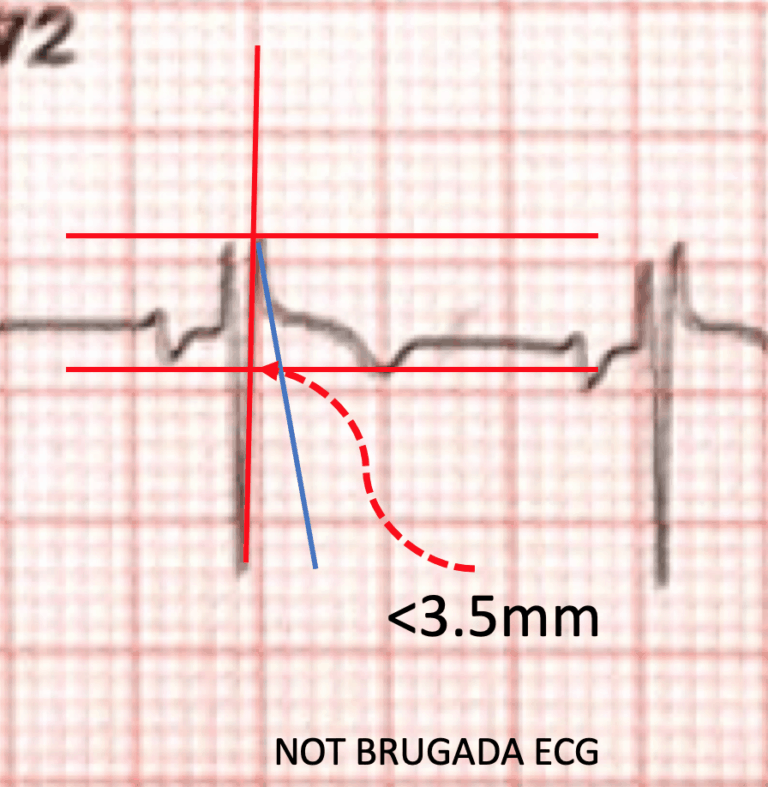 Brugada Syndrome | Emergency Medicine Education | Resus