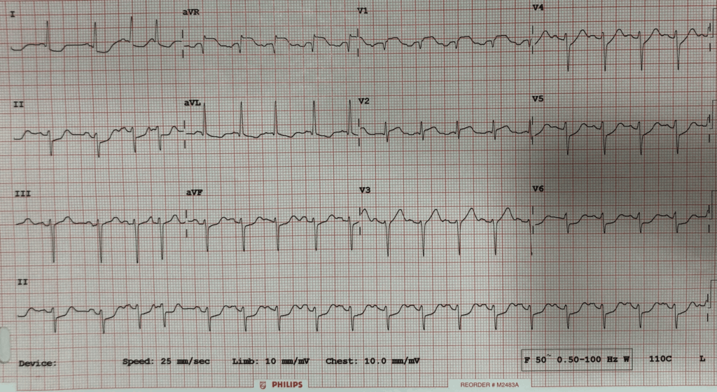 ST Elevation in aVR | Emergency Medicine Education | Resus