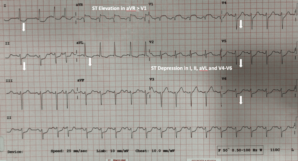 ST Elevation in aVR | Emergency Medicine Education | Resus