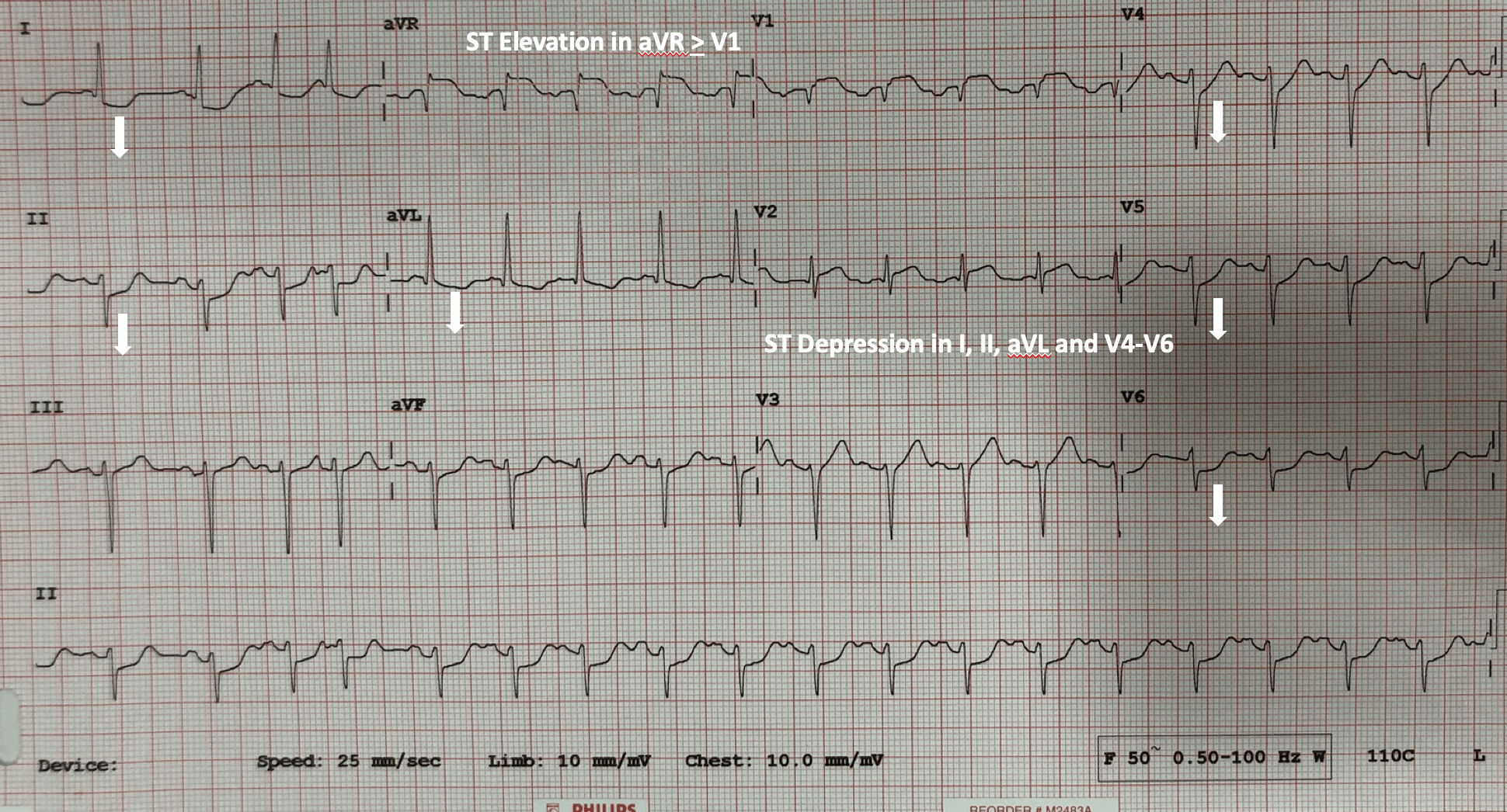 ST Elevation in aVR | Emergency Medicine Education | Resus