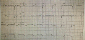 Dextrocardia: Can you pick it on ECG? | Resus