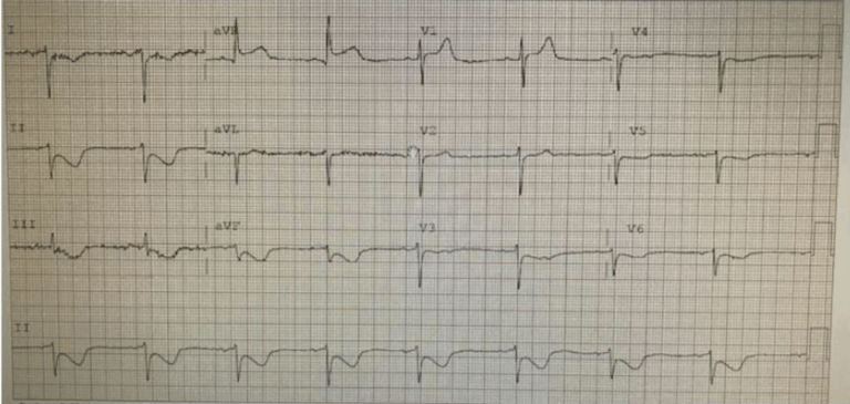 Dextrocardia: Can you pick it on ECG? | Resus