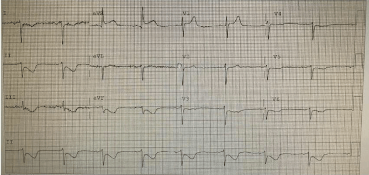 Dextrocardia: Can you pick it on ECG? | Resus