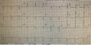 Dextrocardia: Can you pick it on ECG? | Resus