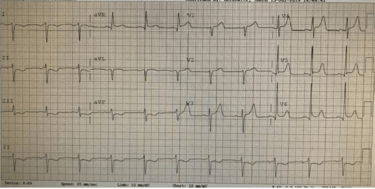 Dextrocardia: Can you pick it on ECG? | Resus