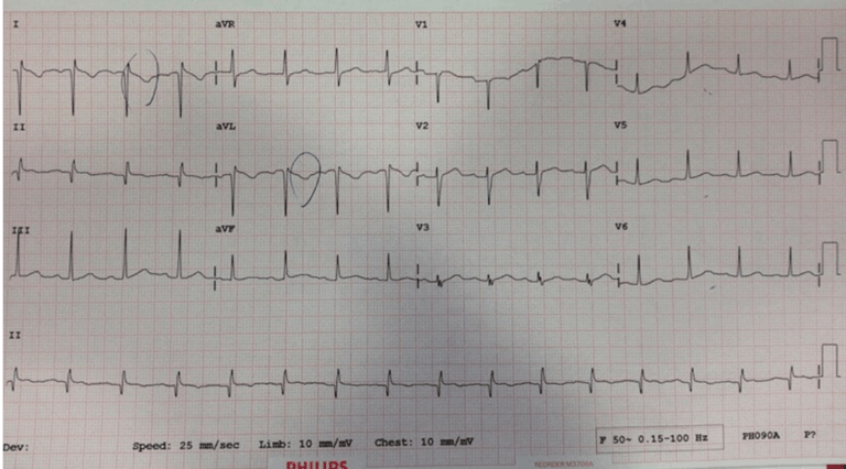 Dextrocardia: Can you pick it on ECG? | Resus