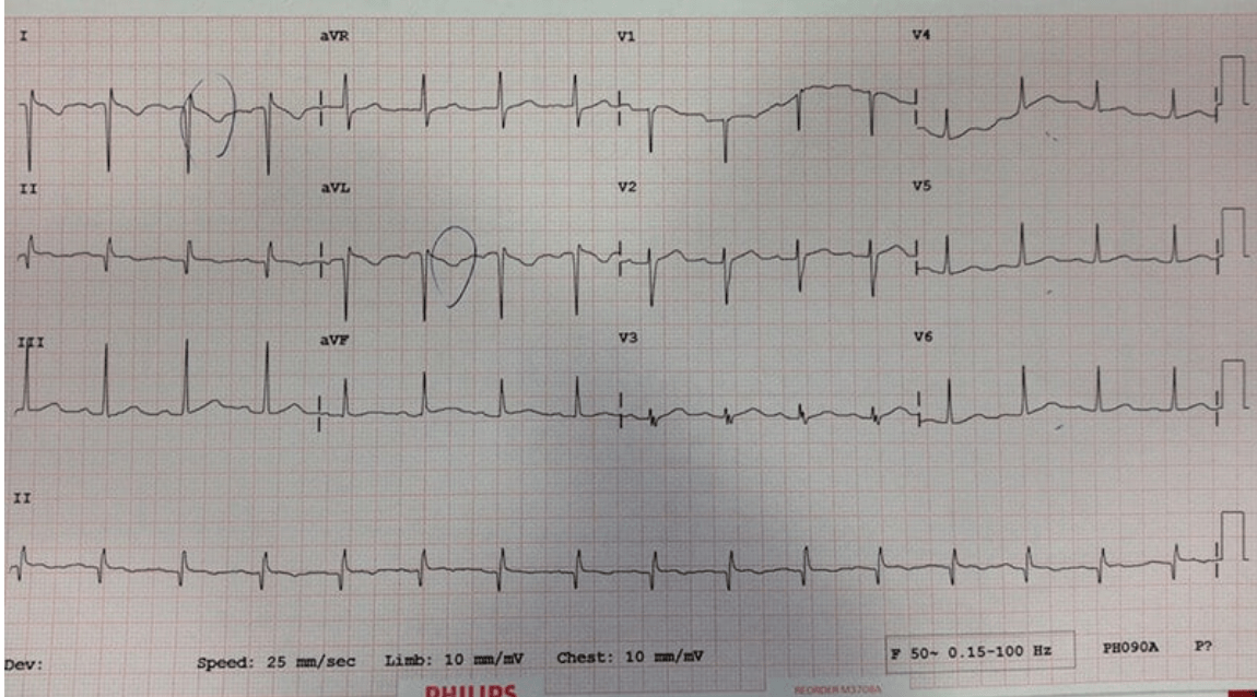 Dextrocardia: Can you pick it on ECG? | Resus