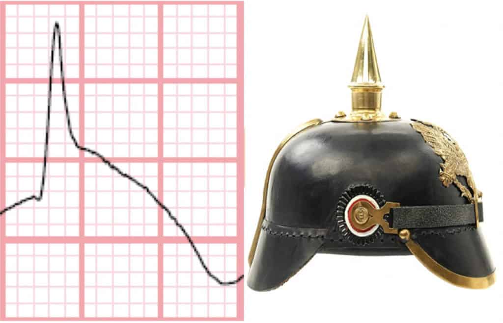 An Ominous ECG Sign | Emergency Medicine Education | Resus