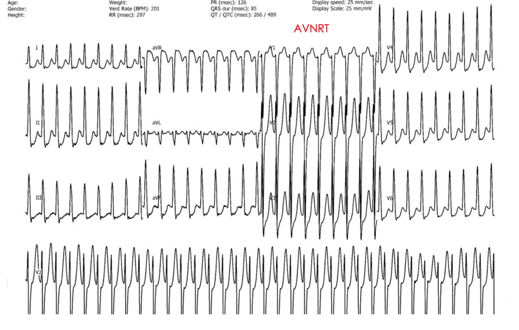 Is SVT an ischaemic arrhythmia? | Resus