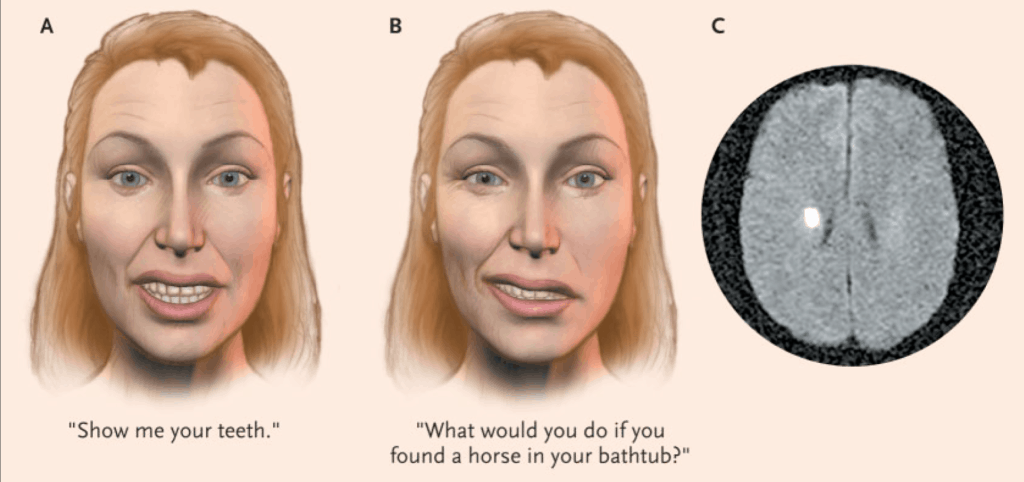 Facial Nerve Palsy examination | Resus