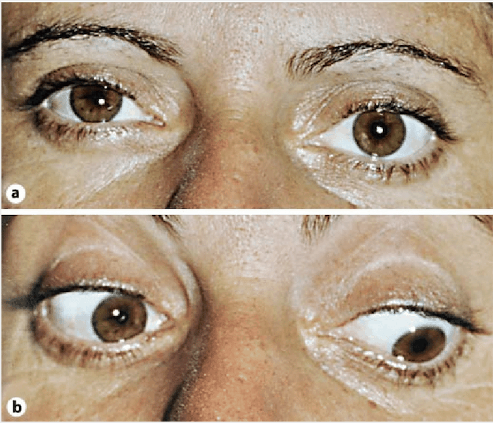Can you diagnose the cause of DIPLOPIA? Take the test. | Resus