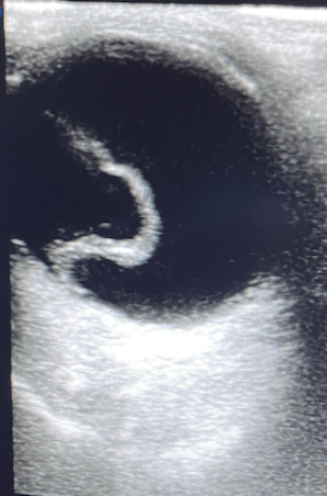 Retinal Detachment | Emergency Medicine Education | Resus
