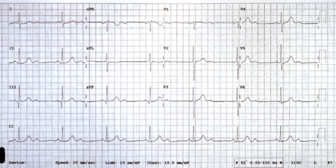 4 Things to do to never miss the MOBITZ BLOCK | Resus