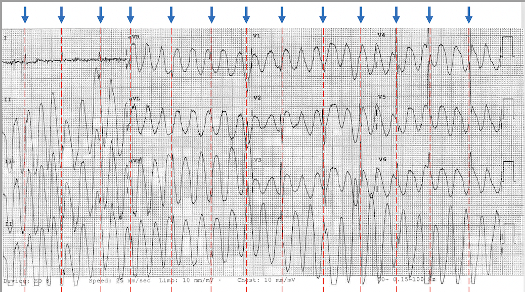 A Patient with Wide Complex Tachycardia | Resus