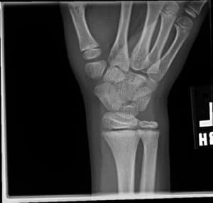 Pronator Quadratus Sign | Resus