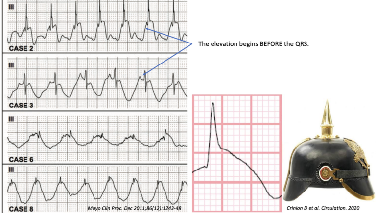 A 35 yo woman with Septic Shock | Resus