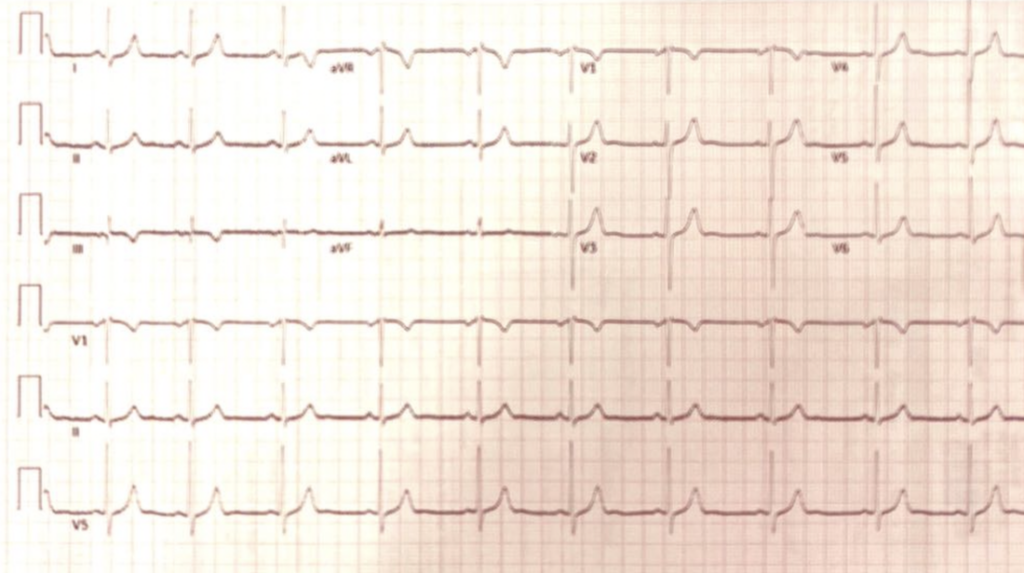 31 yo female, G1P0 with pleuritic chest pain | Resus