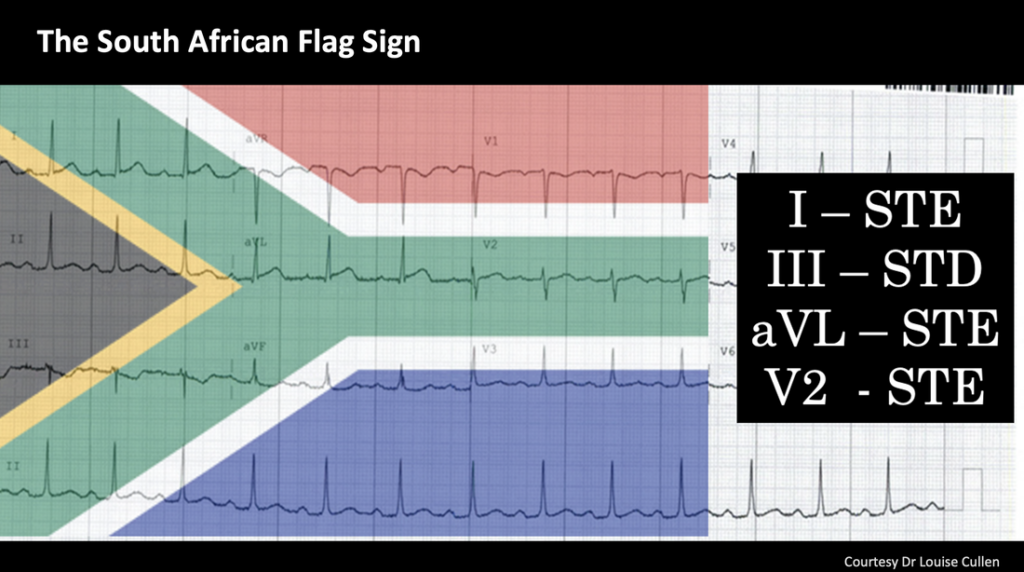 IT'S TIME FOR A QUICK ECG QUIZ! | Resus
