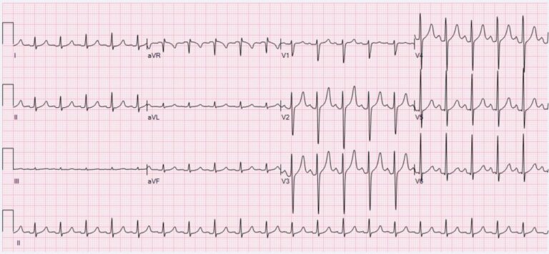 Epicardial Fat Necrosis | Emergency Medicine Education