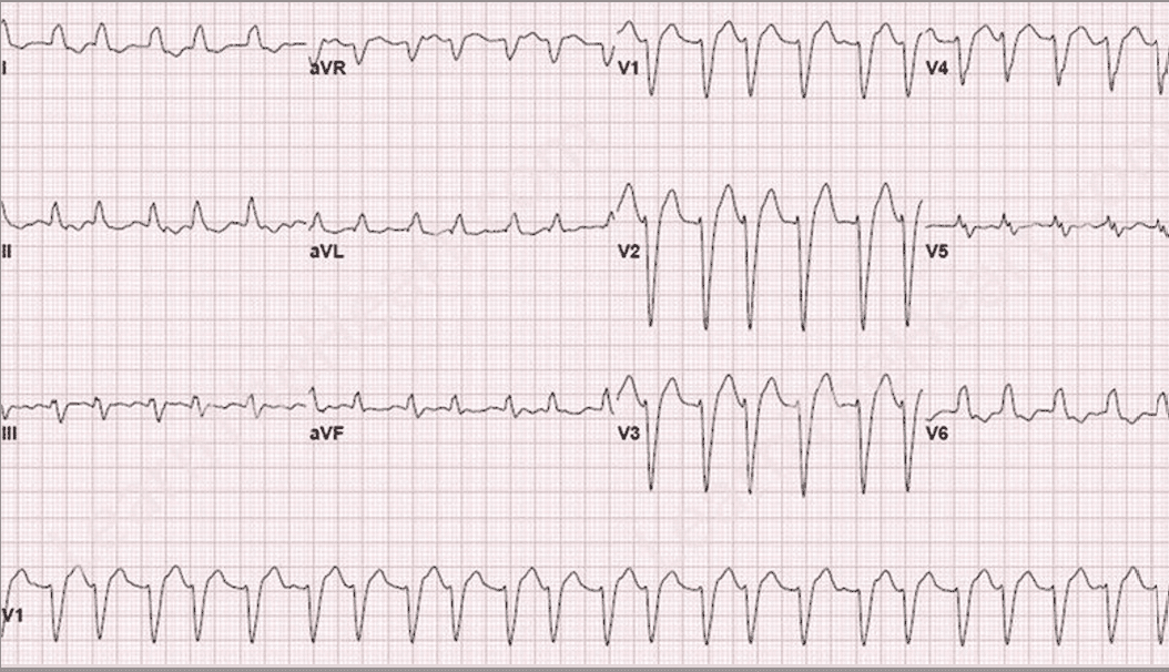 ECG of the Week | Emergency Medicine Education | Resus