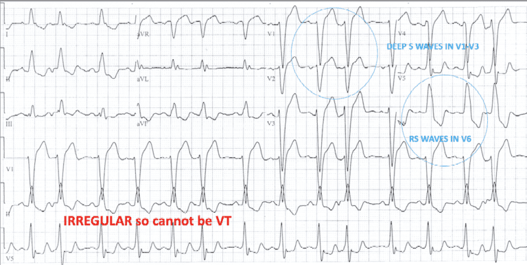 ECG of the Week | Emergency Medicine Education | Resus