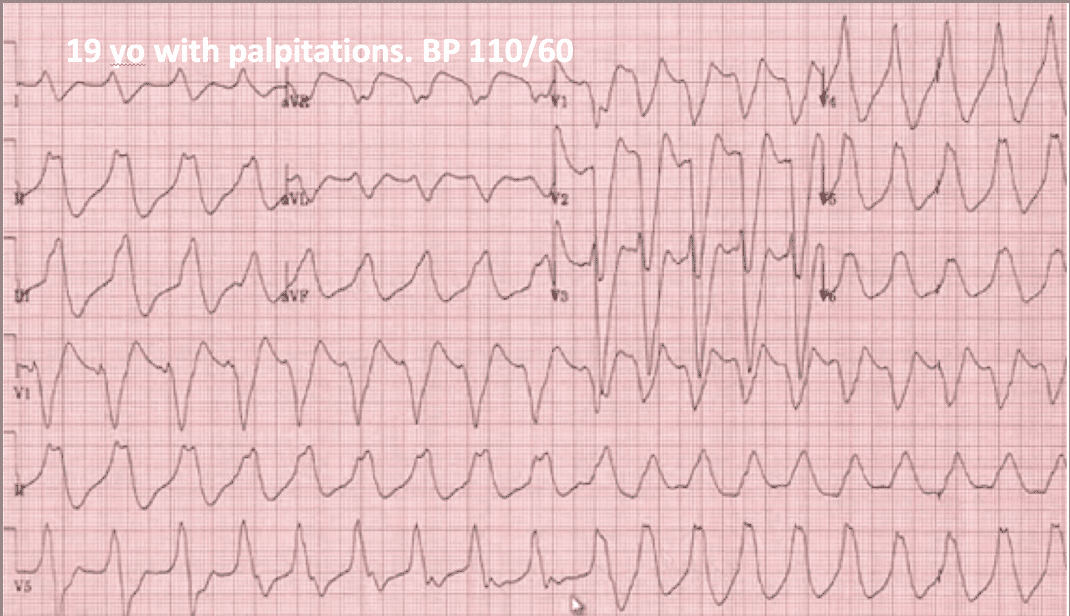 ECG of the Week | Emergency Medicine Education | Resus