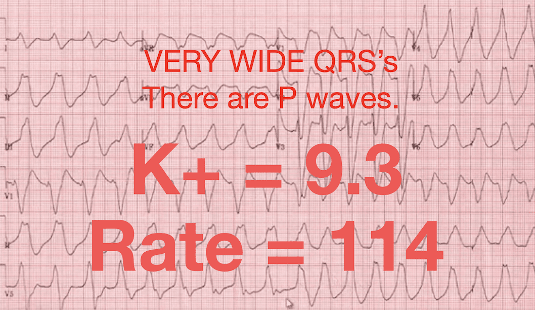 ECG of the Week | Emergency Medicine Education | Resus