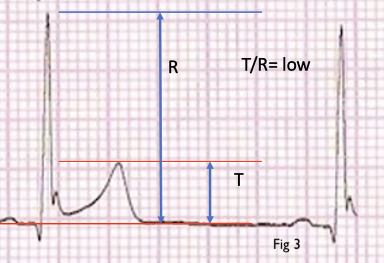 Early Depolarisation and Sudden Cardiac Death | Resus