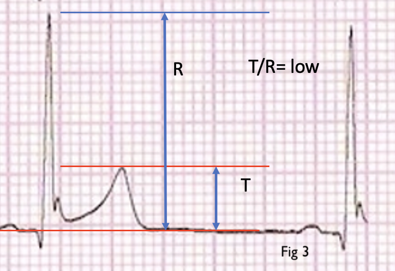Early Depolarisation and Sudden Cardiac Death | Resus