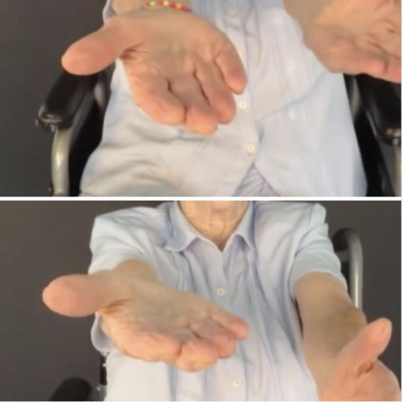 Hoover's Sign and Functional Weakness | Resus