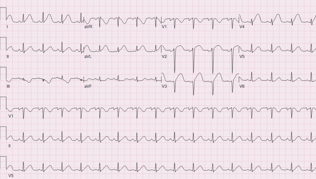 Spontaneous Coronary Artery Dissection(SCAD) | Resus