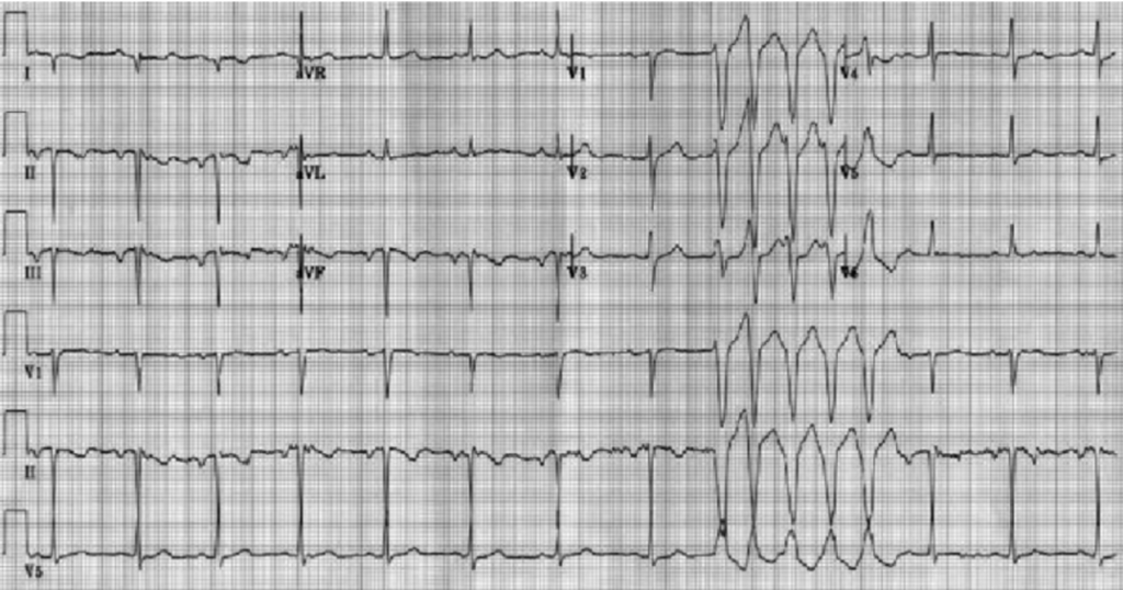 Reperfusion Arrhythmias | Resus