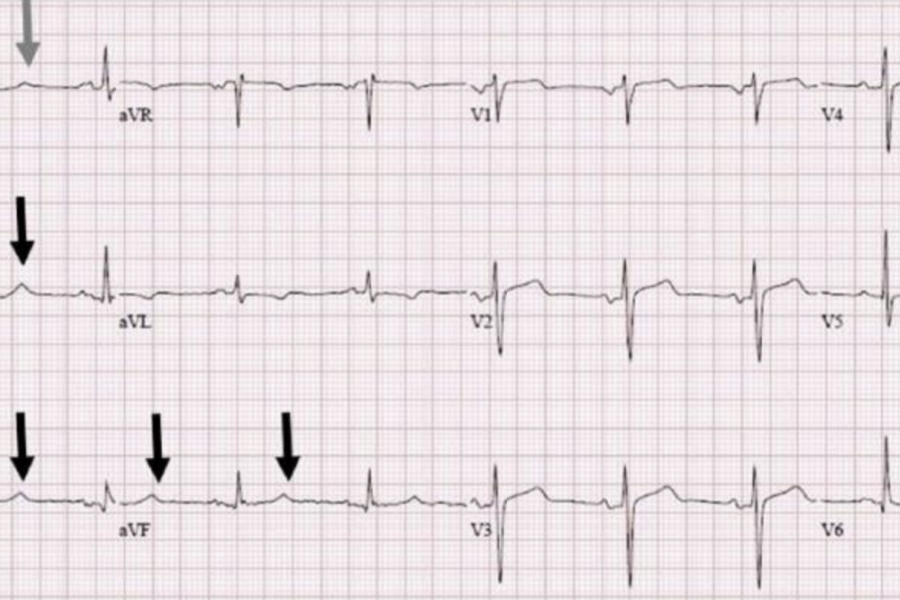 ECG Of The Week Category | Emergency Medicine | Resus