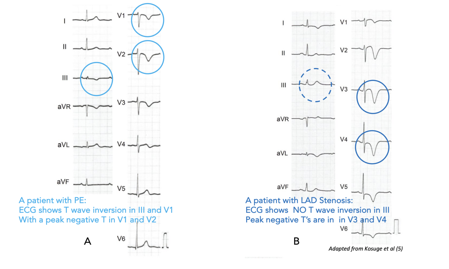Can the ECG help us differentiate PE from ACS? | Resus